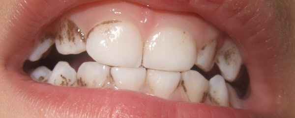 Taches noires sur les dents : comment les enlever