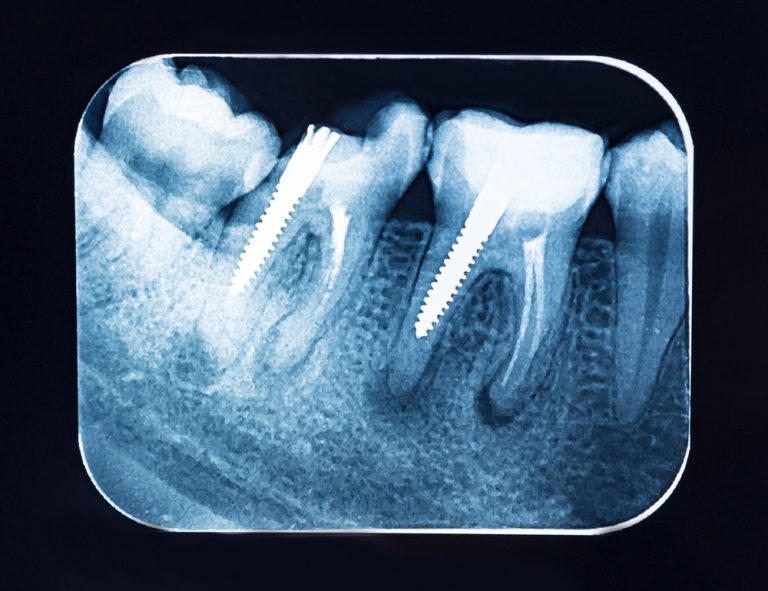 Dent sur pivot : quelle est la différence avec l'implant