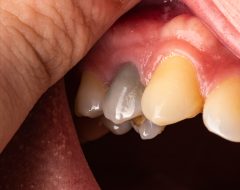 Dent nécrosée : comment traiter cette infection dentaire