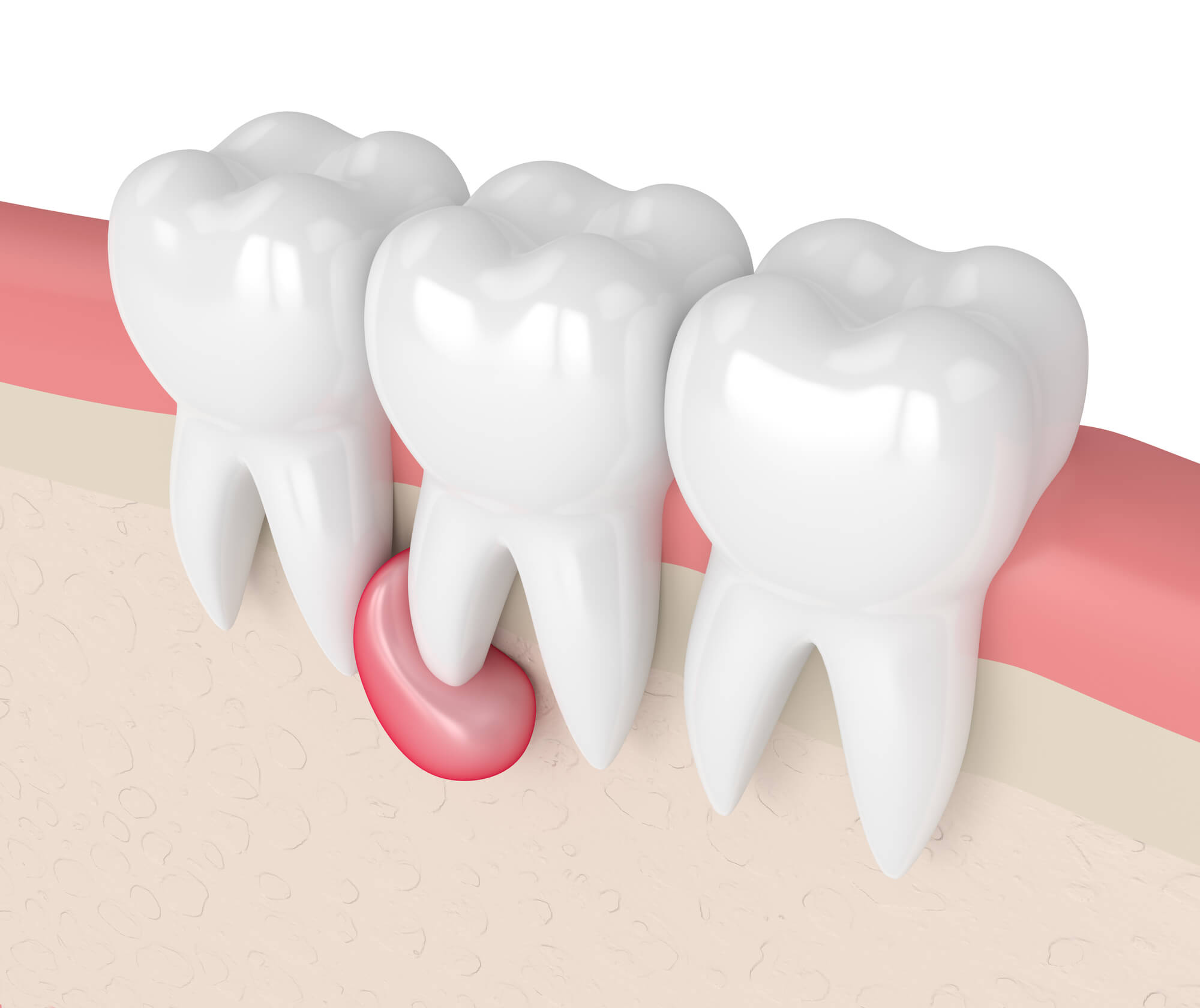 Quistes dentales: todo sobre los quistes en la boca