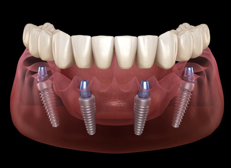Tout savoir sur les prothèses dentaires sur implants