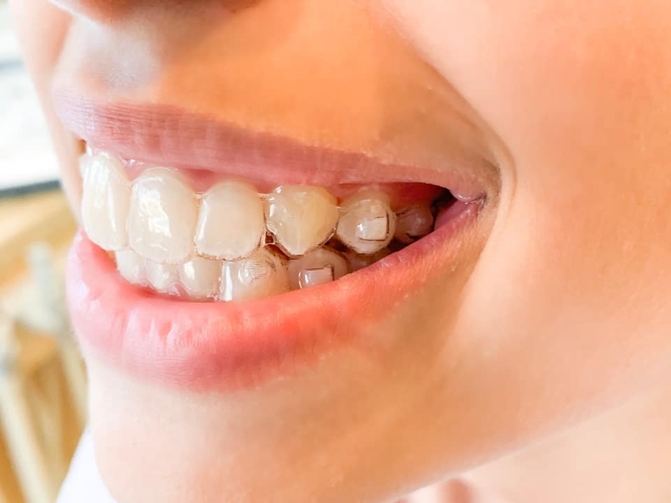Invisalign Full: el tratamiento completo de Invisalign